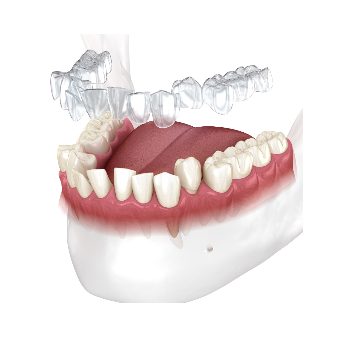 Discover Your Perfect Smile with Invisalign in Plymouth